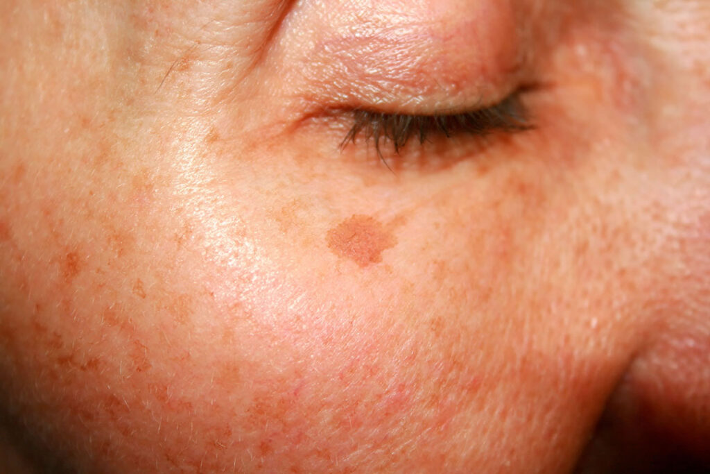 Manchas solares en la piel: tratamientos contra los lentigos