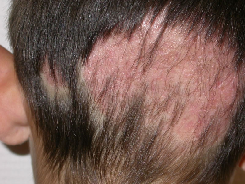 Enfermedades del Cuero Cabelludo | El Blog de CDN Perfumes